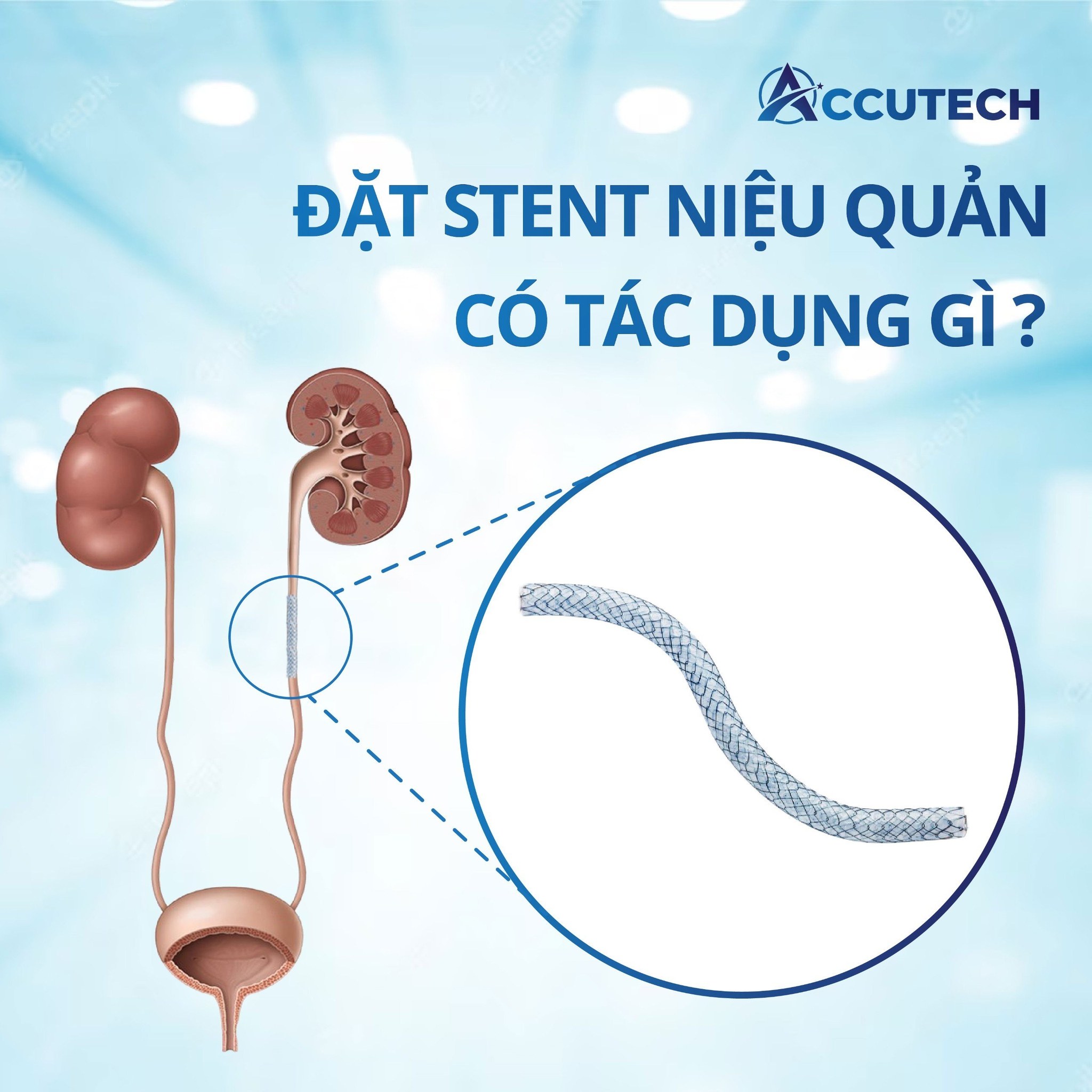 ĐẶT STENT NIỆU QUẢN CÓ TÁC DỤNG GÌ - Công ty Cổ Phần Accutech Việt Nam