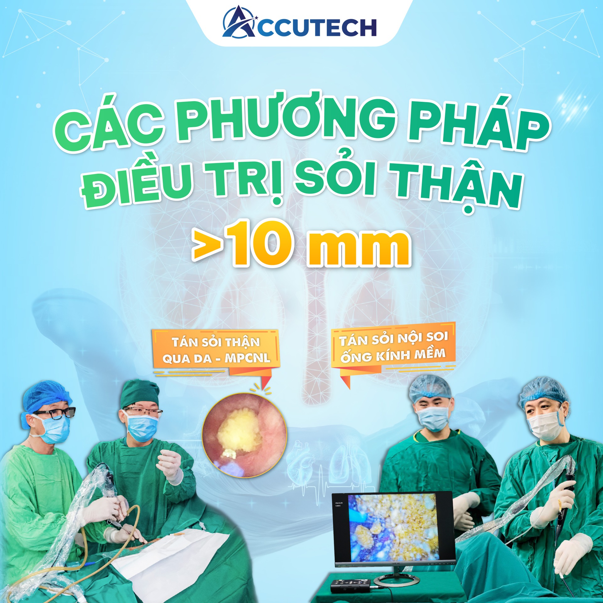 CÁC PHƯƠNG PHÁP ĐIỀU TRỊ SỎI THẬN TRÊN 10 mm - Công ty Cổ Phần Accutech ...